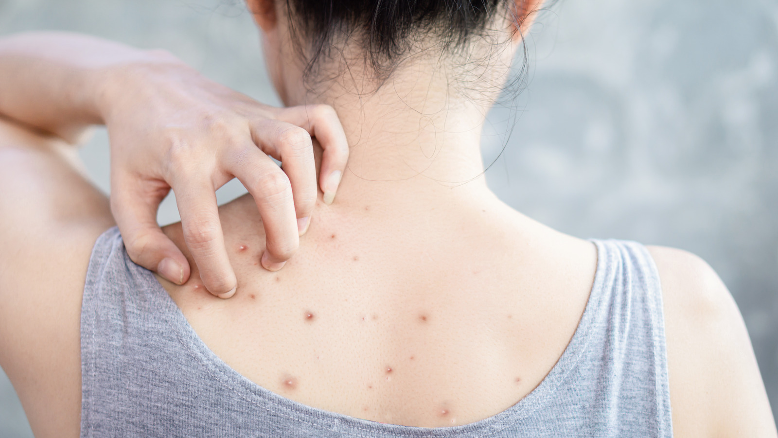 Here's What Causes Your Back Breakouts And How To Treat Them