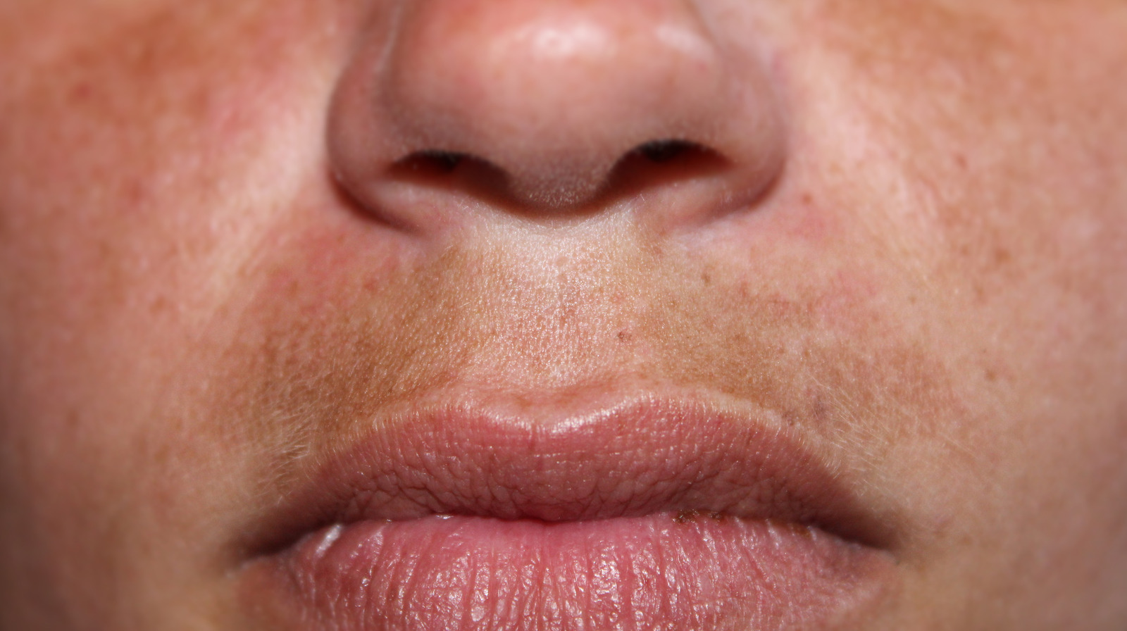 Here's What To Do If You Have A Melasma Mustache
