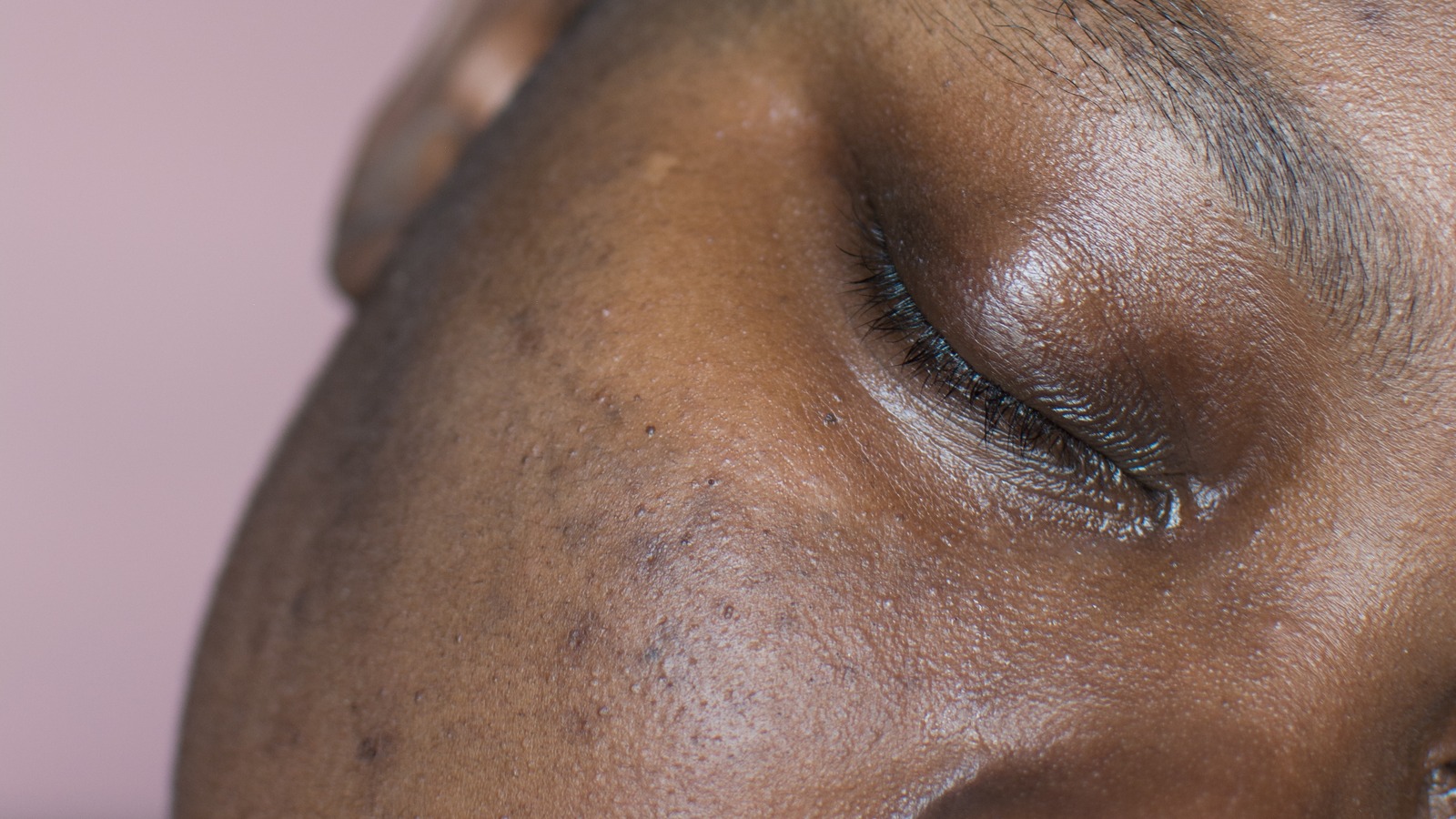 The Best Ingredients For Treating Skin Hyperpigmentation